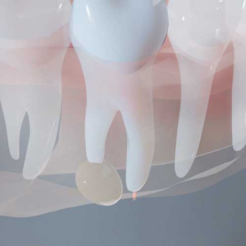 The Truth About Tooth Infections - Leander Dental Care